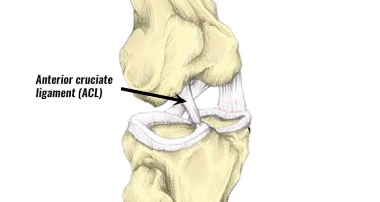 ACL Sprain - SportsRehab.App